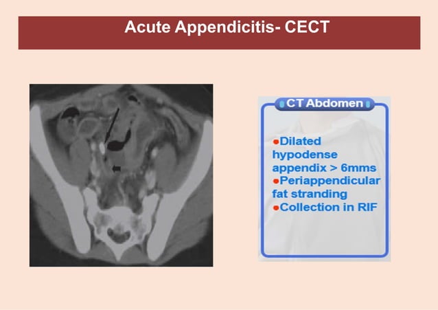 Acute Appendicitis- Appendicectomy- Open & Laparoscopic.pdf | Surgery | Medical Health