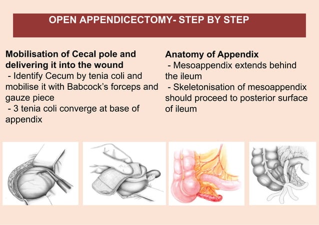 Acute Appendicitis- Appendicectomy- Open & Laparoscopic.pdf | Surgery ...