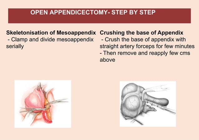 Acute Appendicitis- Appendicectomy- Open & Laparoscopic.pdf | Surgery ...