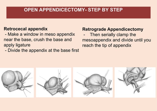 Acute Appendicitis- Appendicectomy- Open & Laparoscopic.pdf | Surgery ...