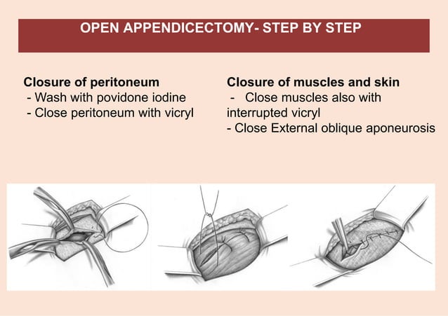 Acute Appendicitis- Appendicectomy- Open & Laparoscopic.pdf | Surgery ...