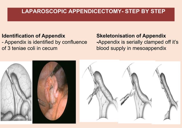 Acute Appendicitis- Appendicectomy- Open & Laparoscopic.pdf | Surgery ...