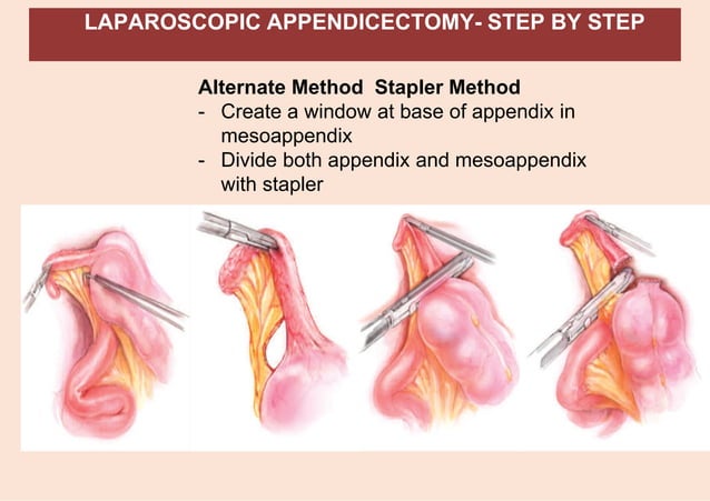 Acute Appendicitis- Appendicectomy- Open & Laparoscopic.pdf | Surgery ...
