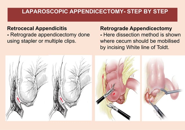 Acute Appendicitis- Appendicectomy- Open & Laparoscopic.pdf | Surgery ...