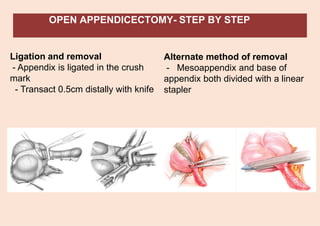 Acute Appendicitis- Appendicectomy- Open & Laparoscopic.pdf