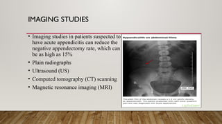 Approach to acute Acute Appendicitis.pptx
