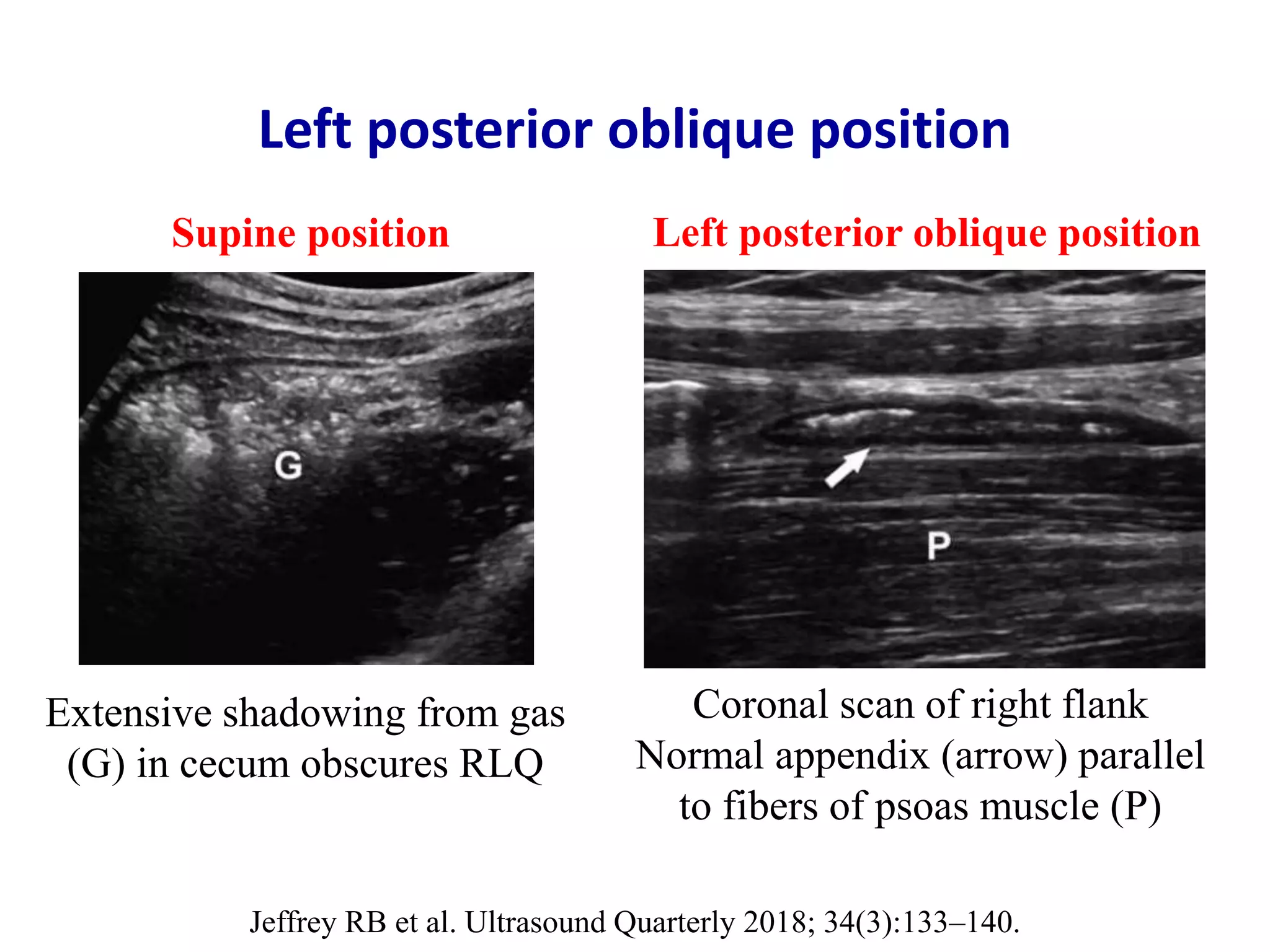 Acute appendicitis - Ultrasound first | PPTX