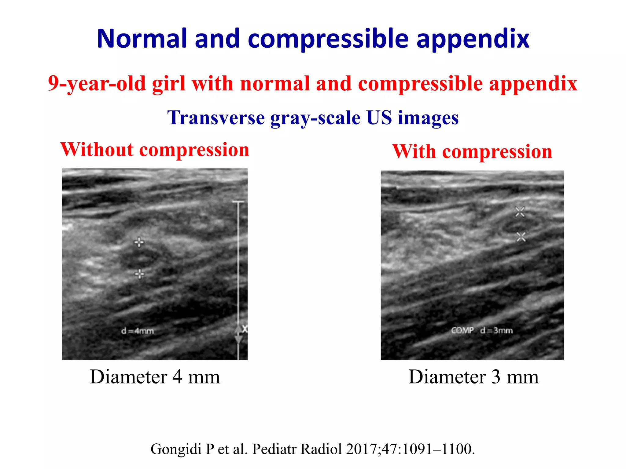 Acute appendicitis - Ultrasound first | PPTX