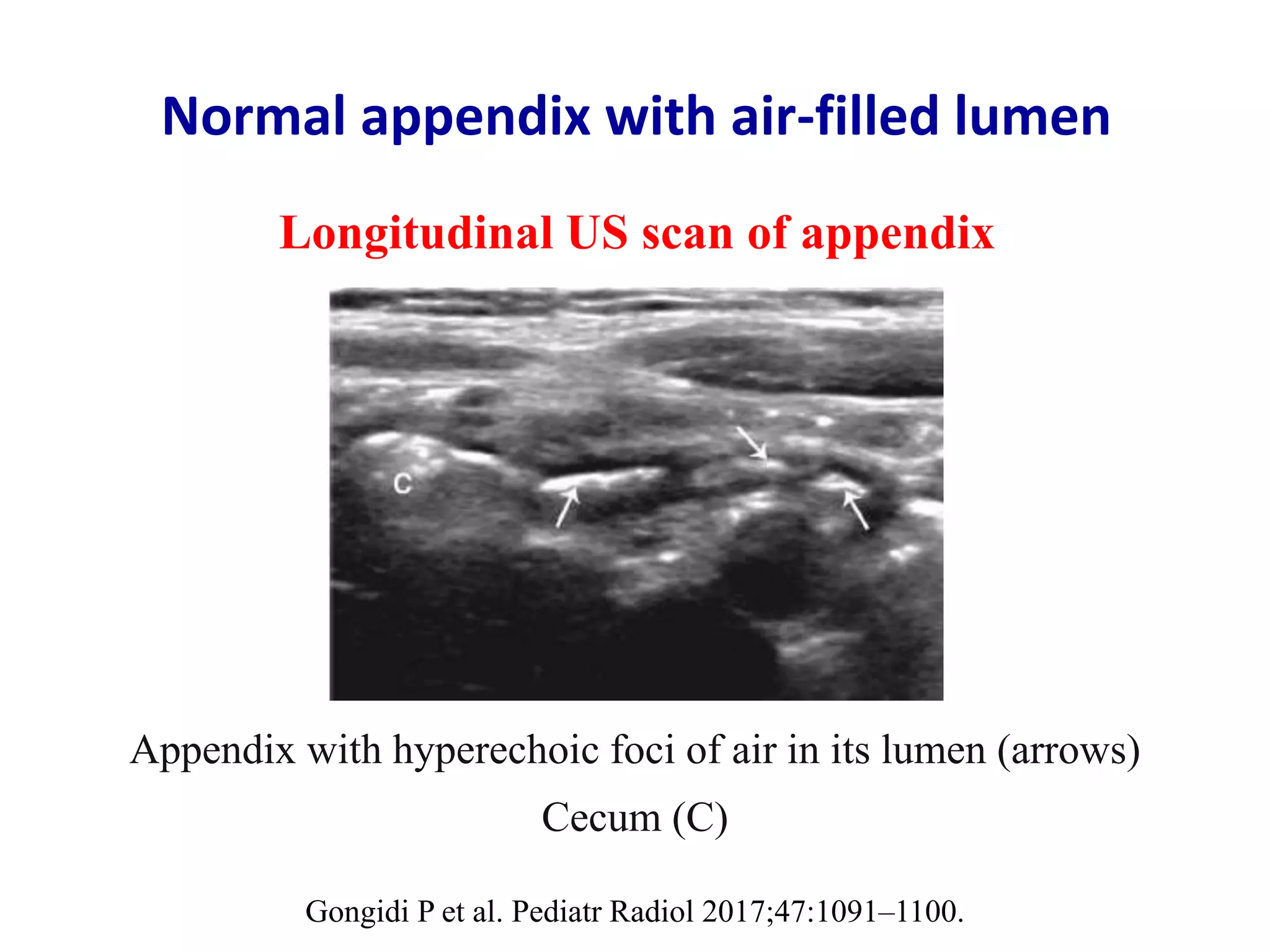 Acute appendicitis - Ultrasound first | PPTX