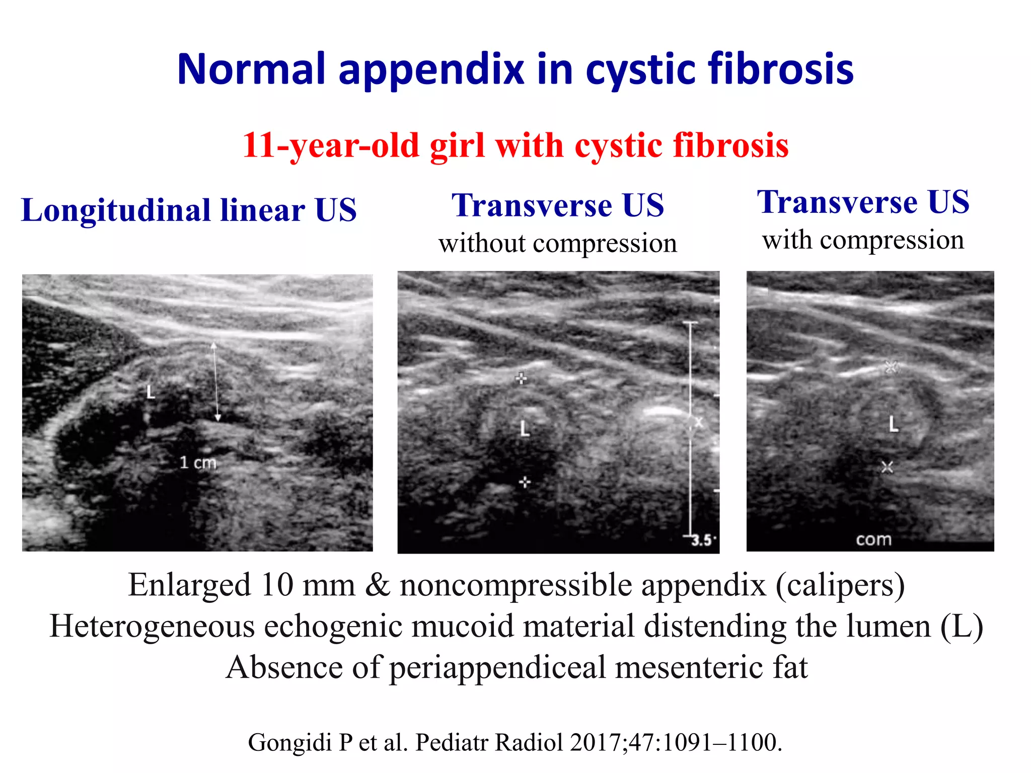 Acute appendicitis - Ultrasound first | PPTX