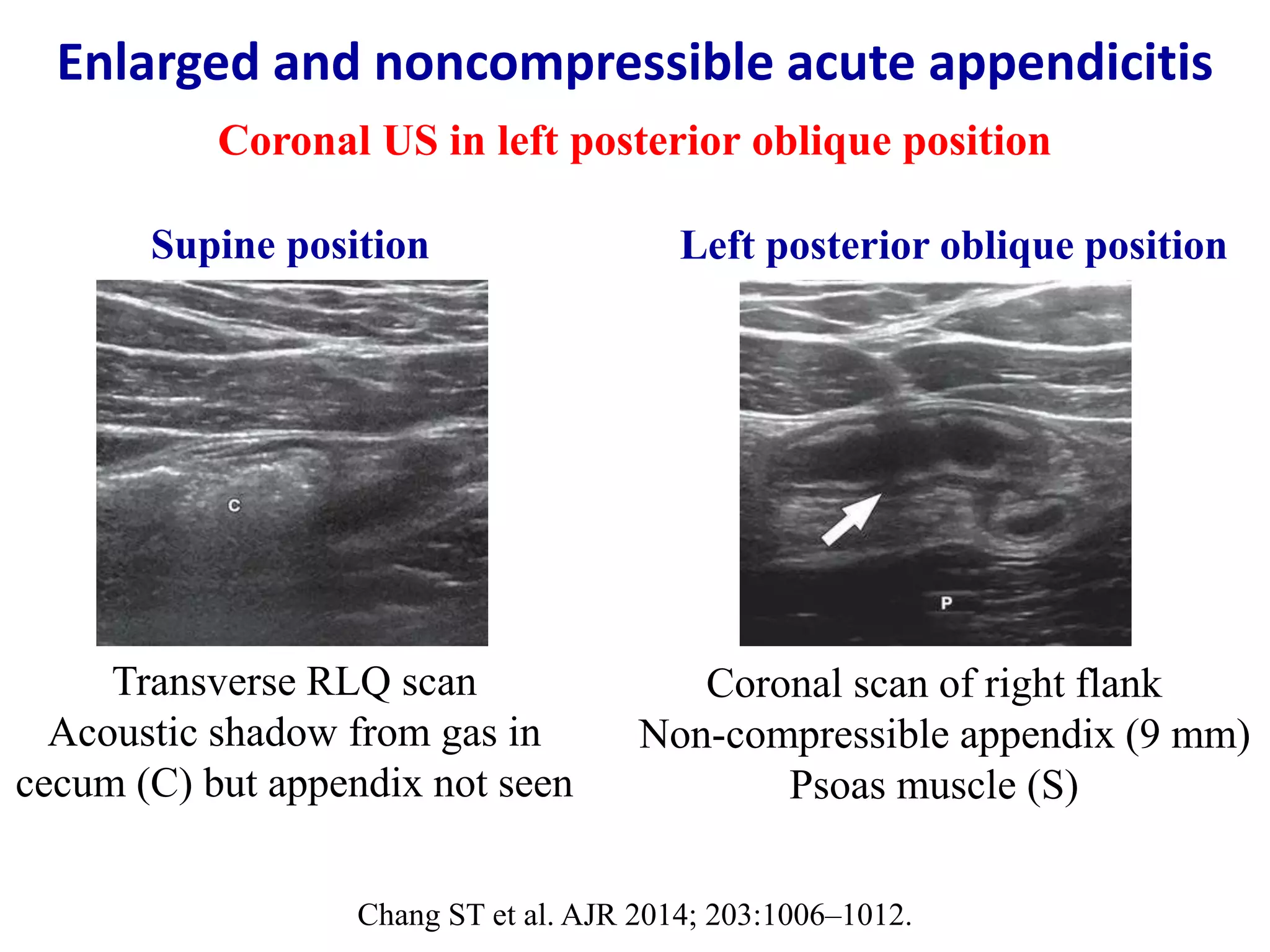 Acute appendicitis - Ultrasound first | PPTX