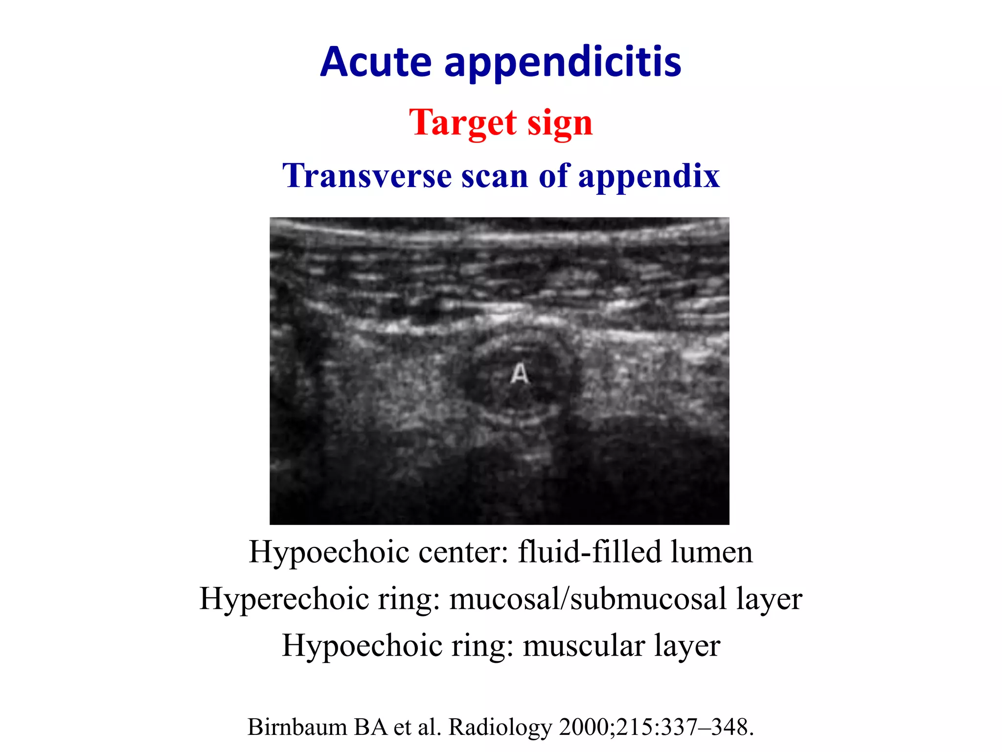 Acute appendicitis - Ultrasound first | PPTX