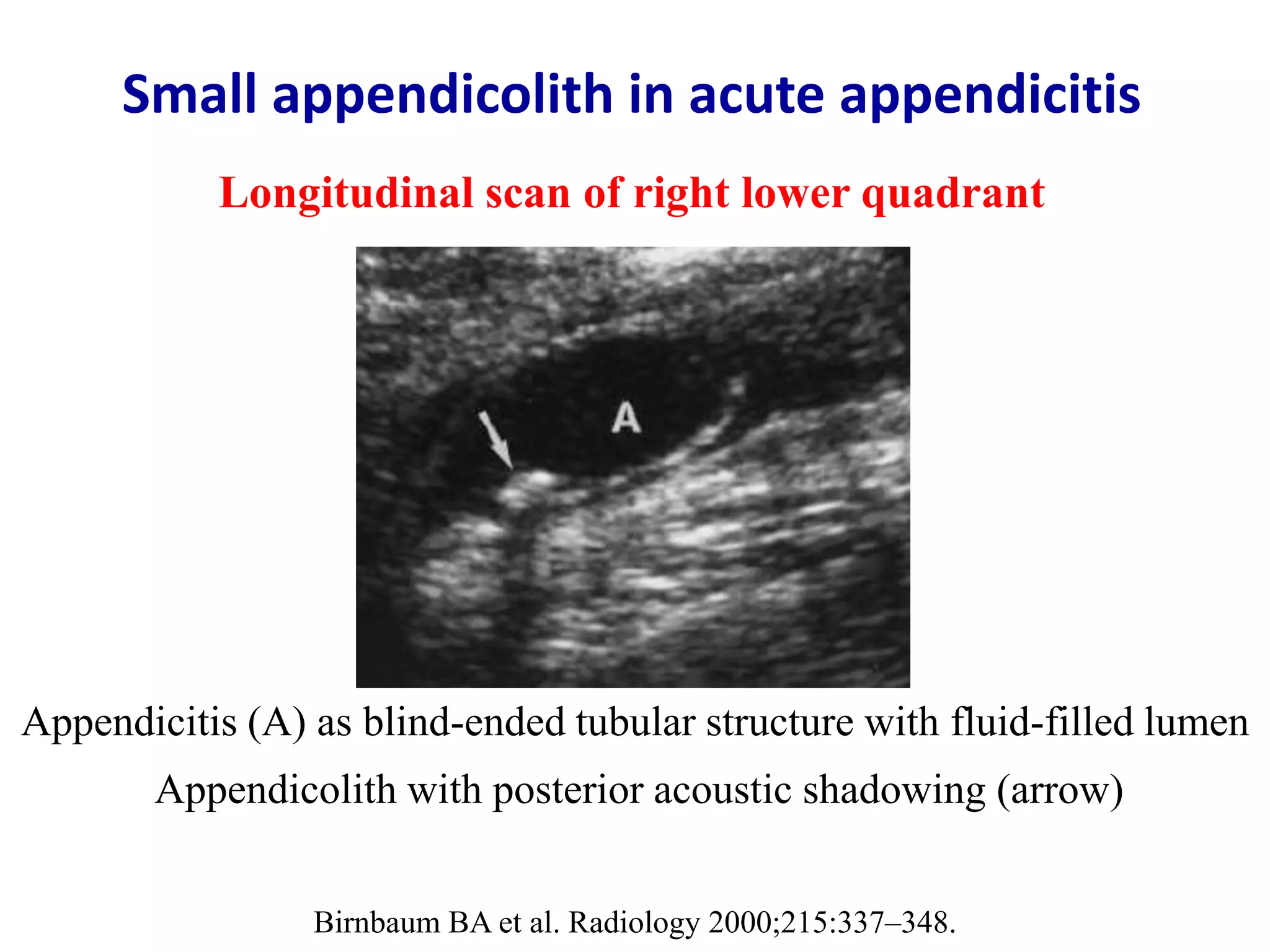 Acute appendicitis - Ultrasound first | PPTX