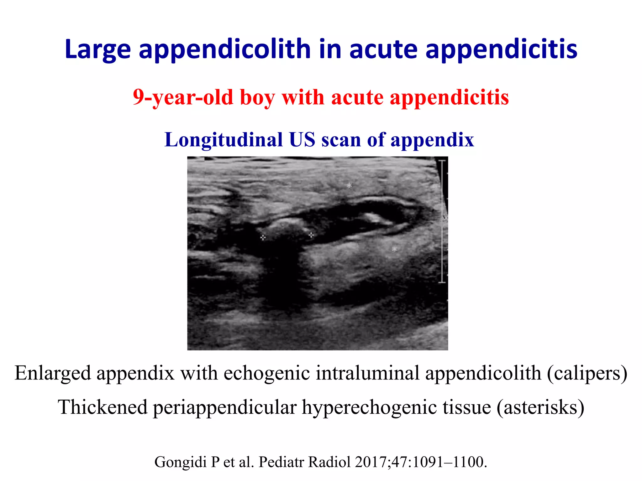 Acute appendicitis - Ultrasound first | PPTX