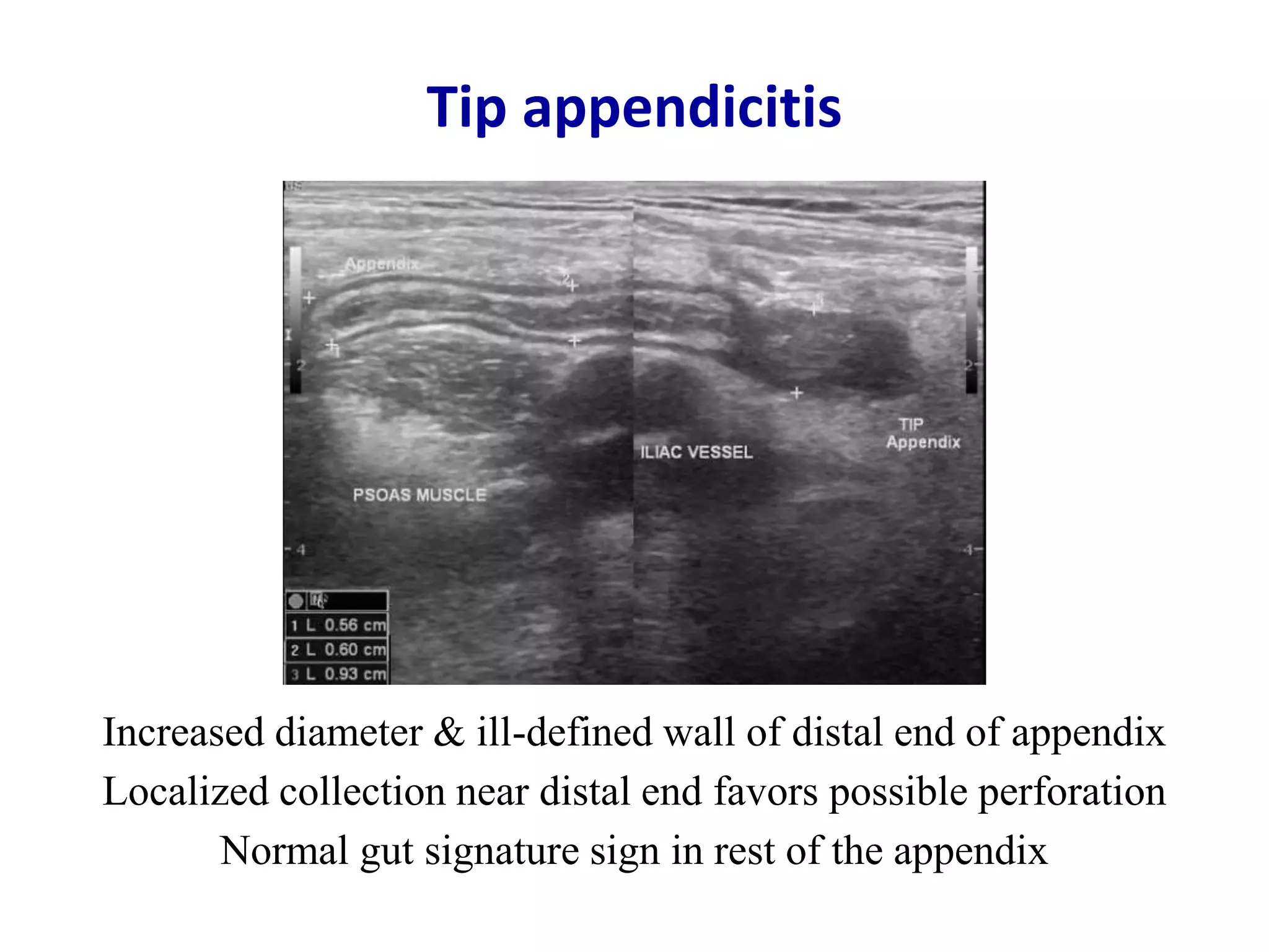 Acute appendicitis - Ultrasound first | PPTX