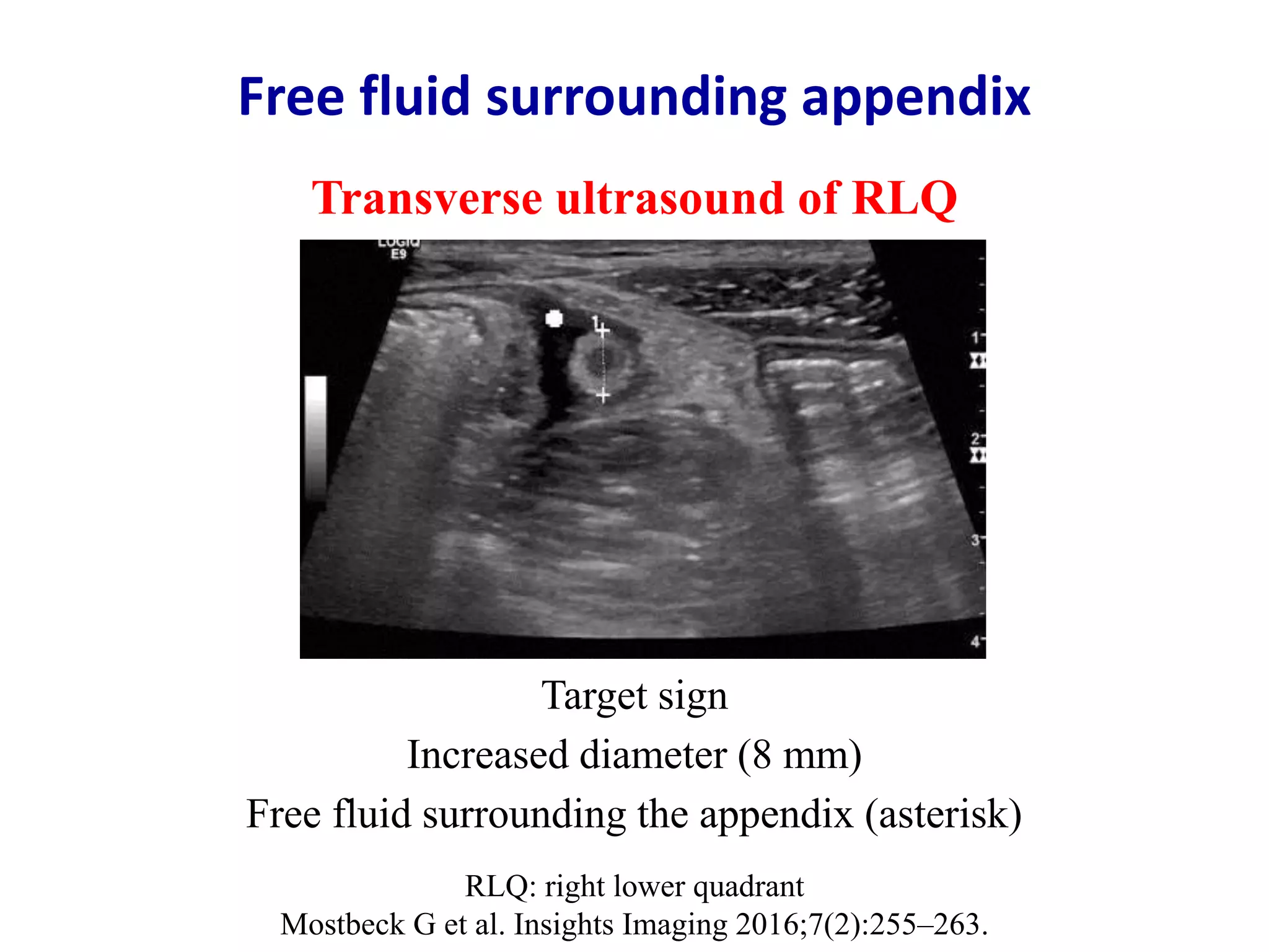 Acute appendicitis - Ultrasound first | PPTX