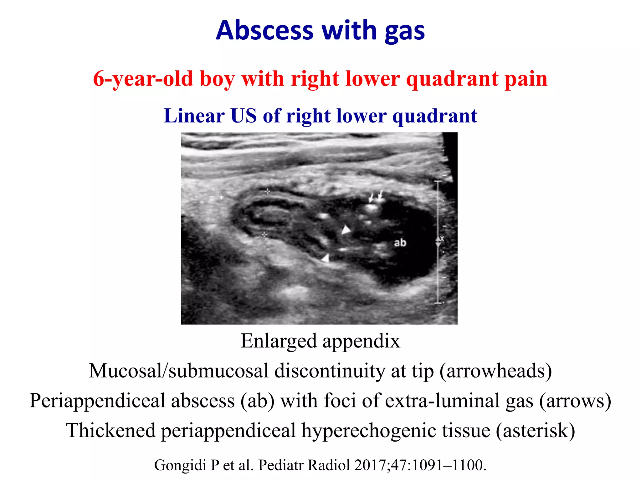 Acute appendicitis - Ultrasound first | PPTX