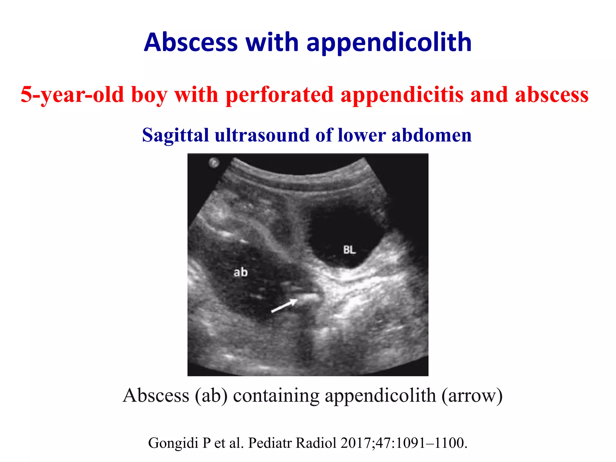 Acute appendicitis - Ultrasound first | PPTX
