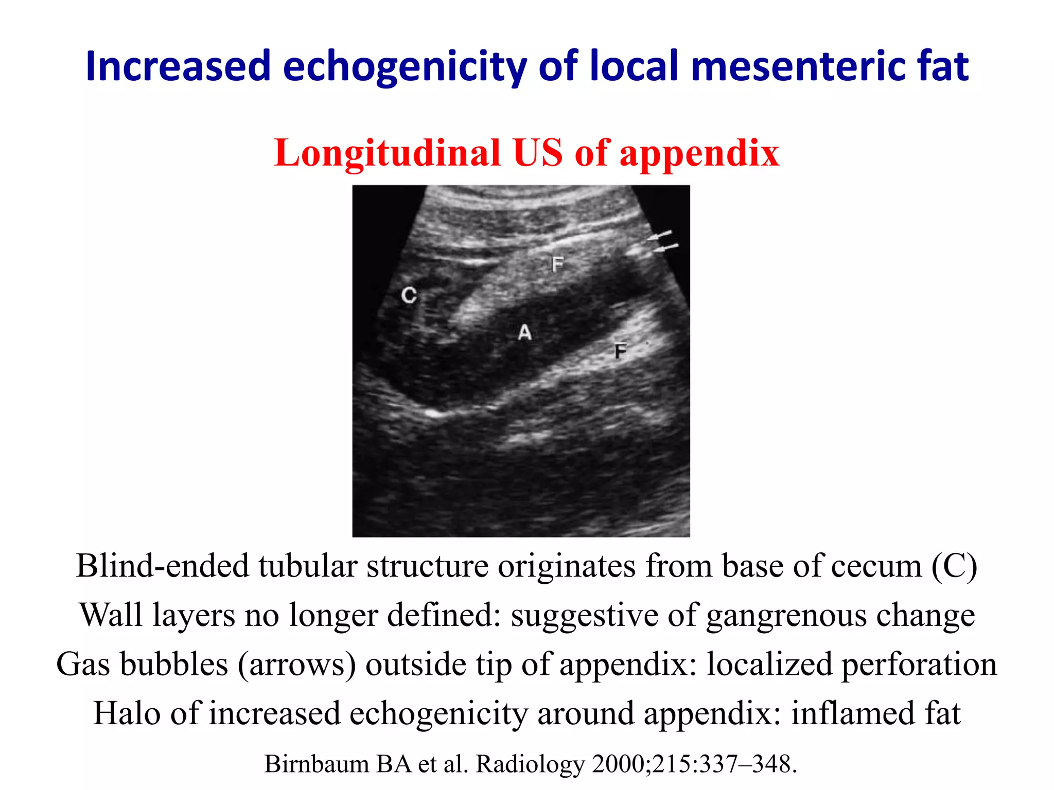 Acute appendicitis - Ultrasound first | PPTX