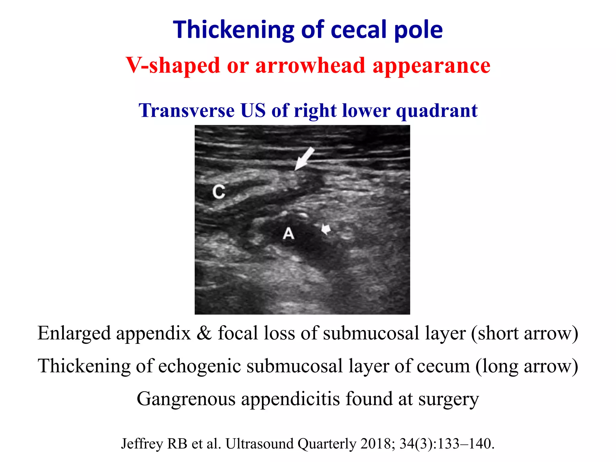 Acute appendicitis - Ultrasound first | PPTX