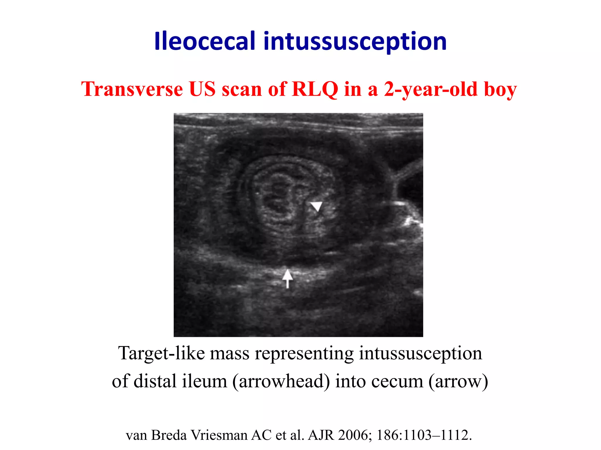 Acute appendicitis - Ultrasound first | PPTX