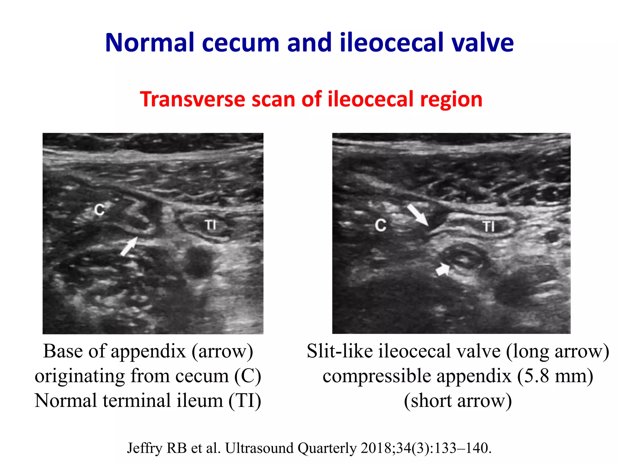 Acute appendicitis - Ultrasound first | PPTX