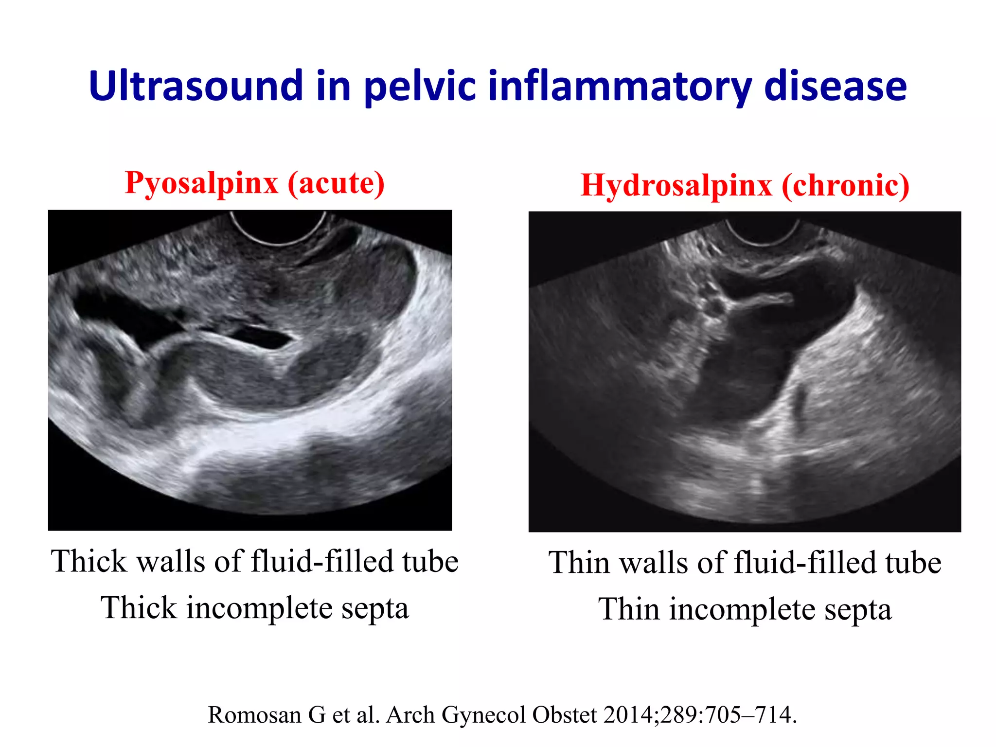 Acute appendicitis - Ultrasound first | PPTX