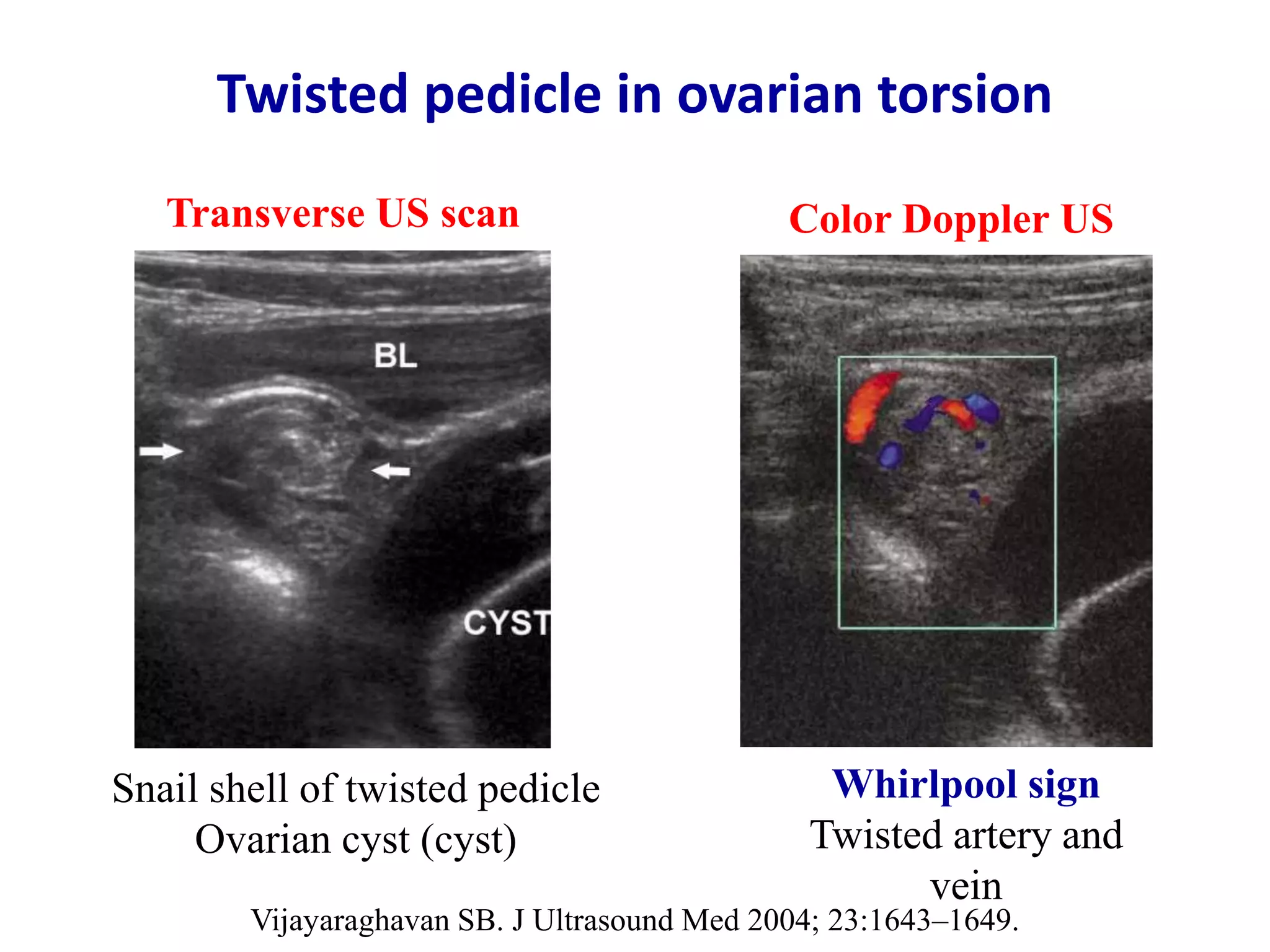 Acute appendicitis - Ultrasound first | PPTX
