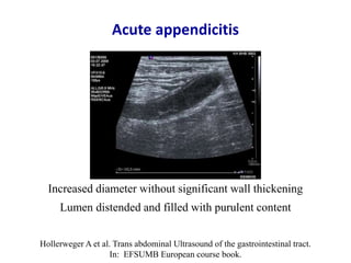 Acute appendicitis - Ultrasound first | PPTX