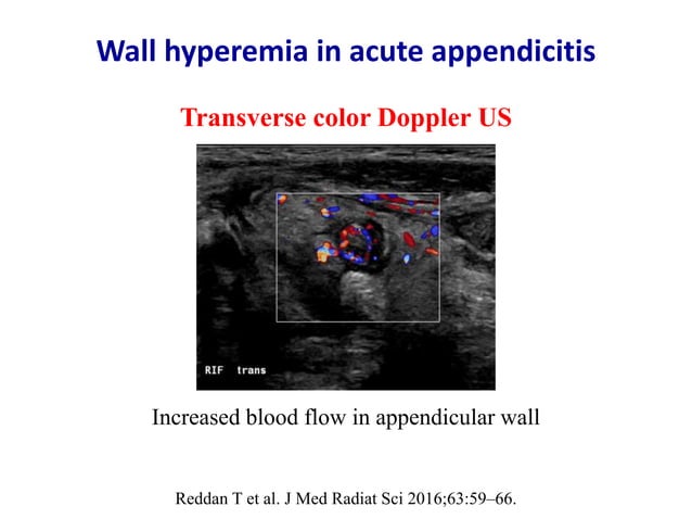 Acute appendicitis - Ultrasound first | PPTX | Pregnancy | Reproductive ...