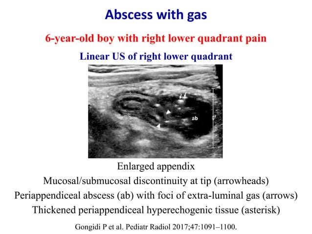 Acute appendicitis - Ultrasound first | PPTX | Pregnancy | Reproductive ...