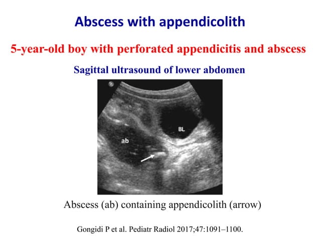 Acute appendicitis - Ultrasound first | PPTX | Pregnancy | Reproductive ...