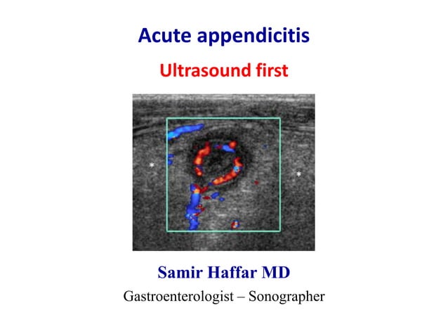 Acute appendicitis - Ultrasound first | PPT