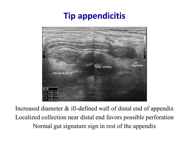 Acute appendicitis - Ultrasound first