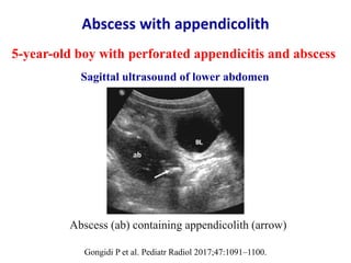 Perforated Appendix Ultrasound