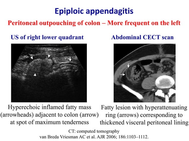 Acute appendicitis - Ultrasound first