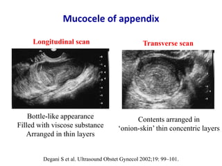 Appendicitis Ultrasound Criteria