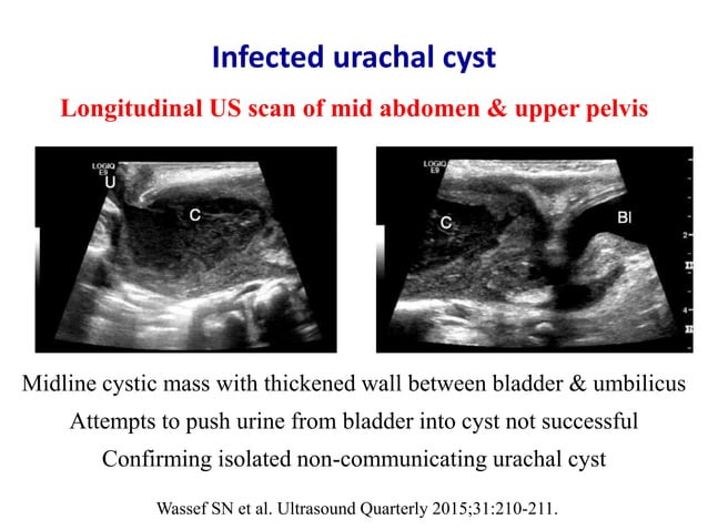 Acute appendicitis - Ultrasound first