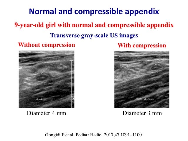 Acute appendicitis - Ultrasound first