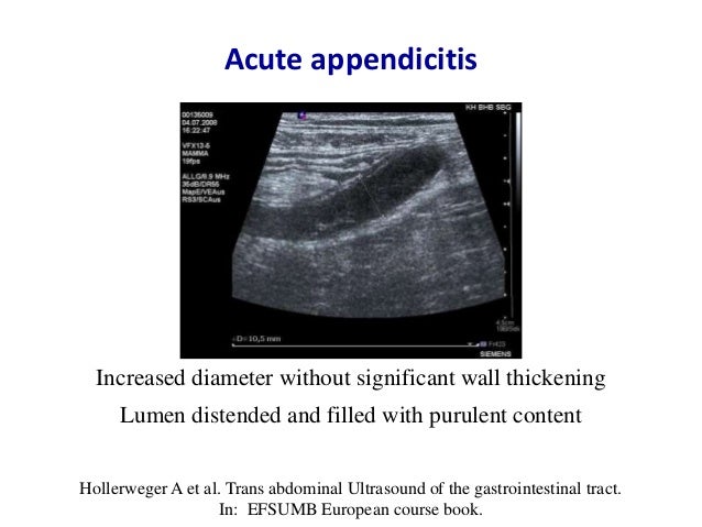 Acute appendicitis - Ultrasound first