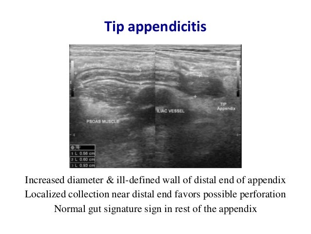 Acute appendicitis - Ultrasound first