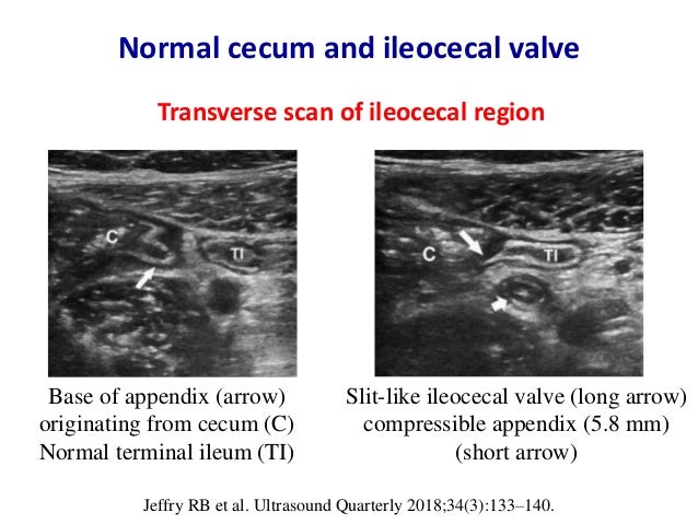 Acute appendicitis - Ultrasound first