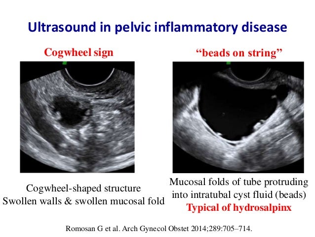 Acute appendicitis - Ultrasound first