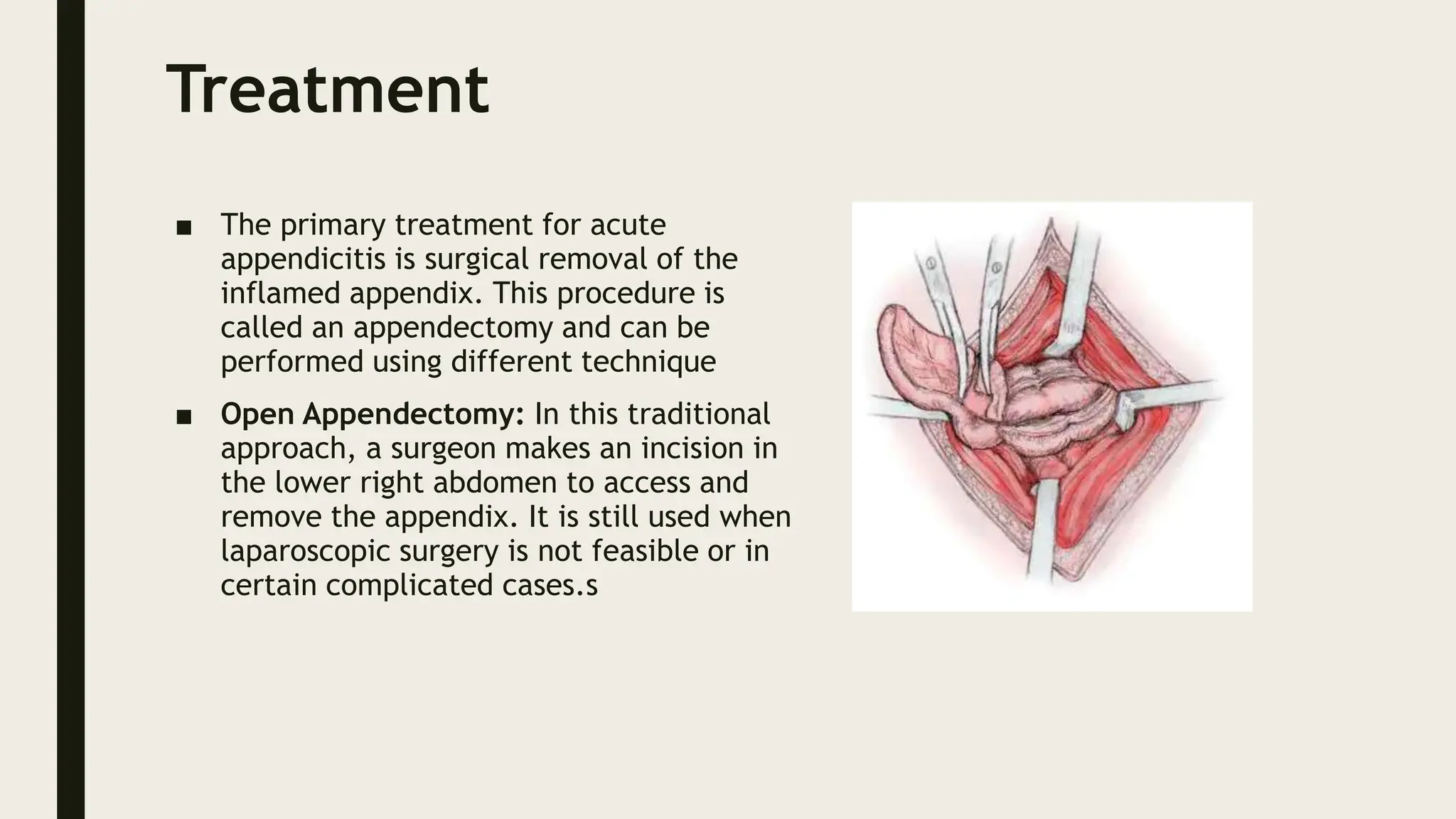 Acute appendicitis .pptx