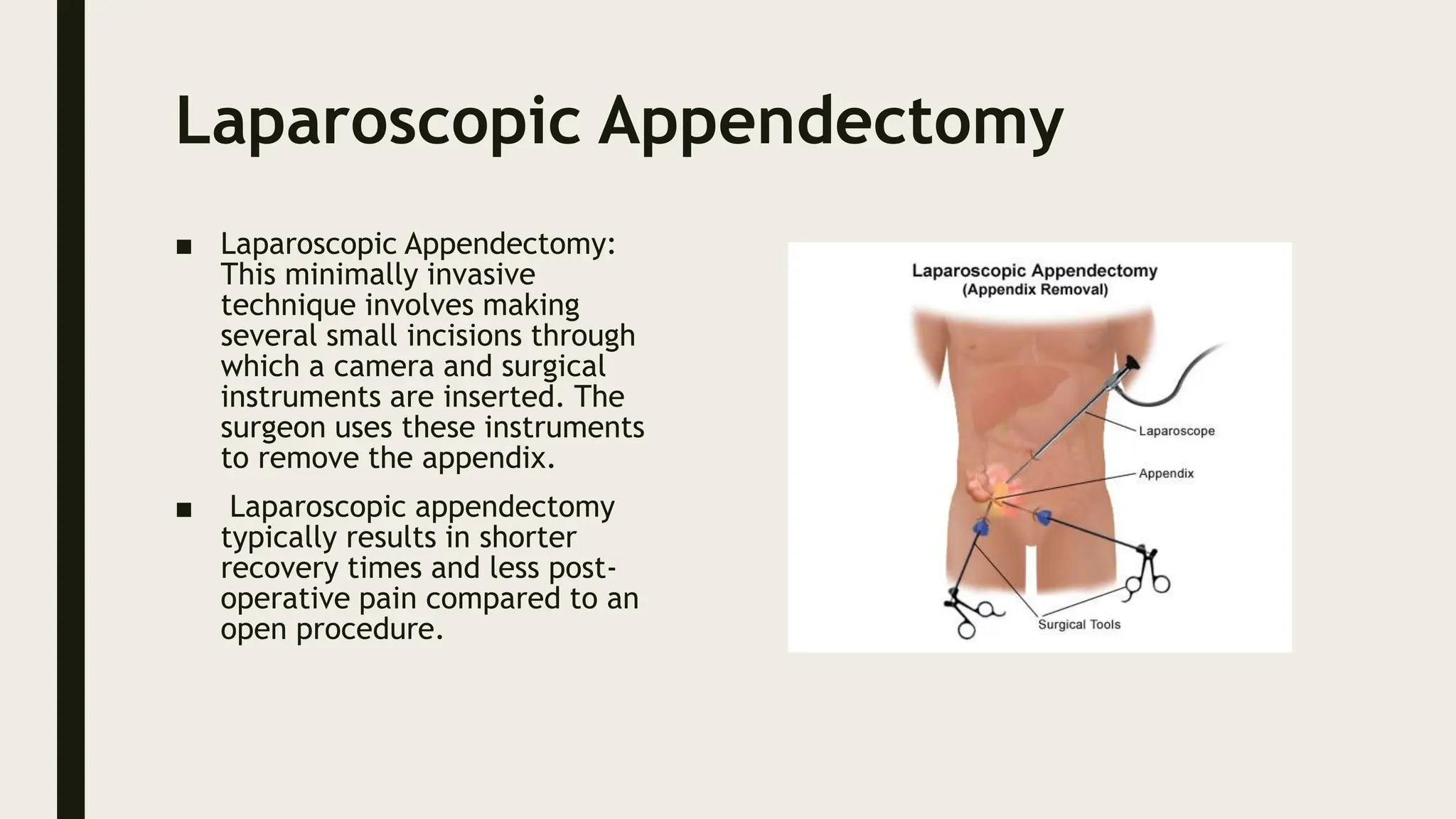Acute appendicitis .pptx