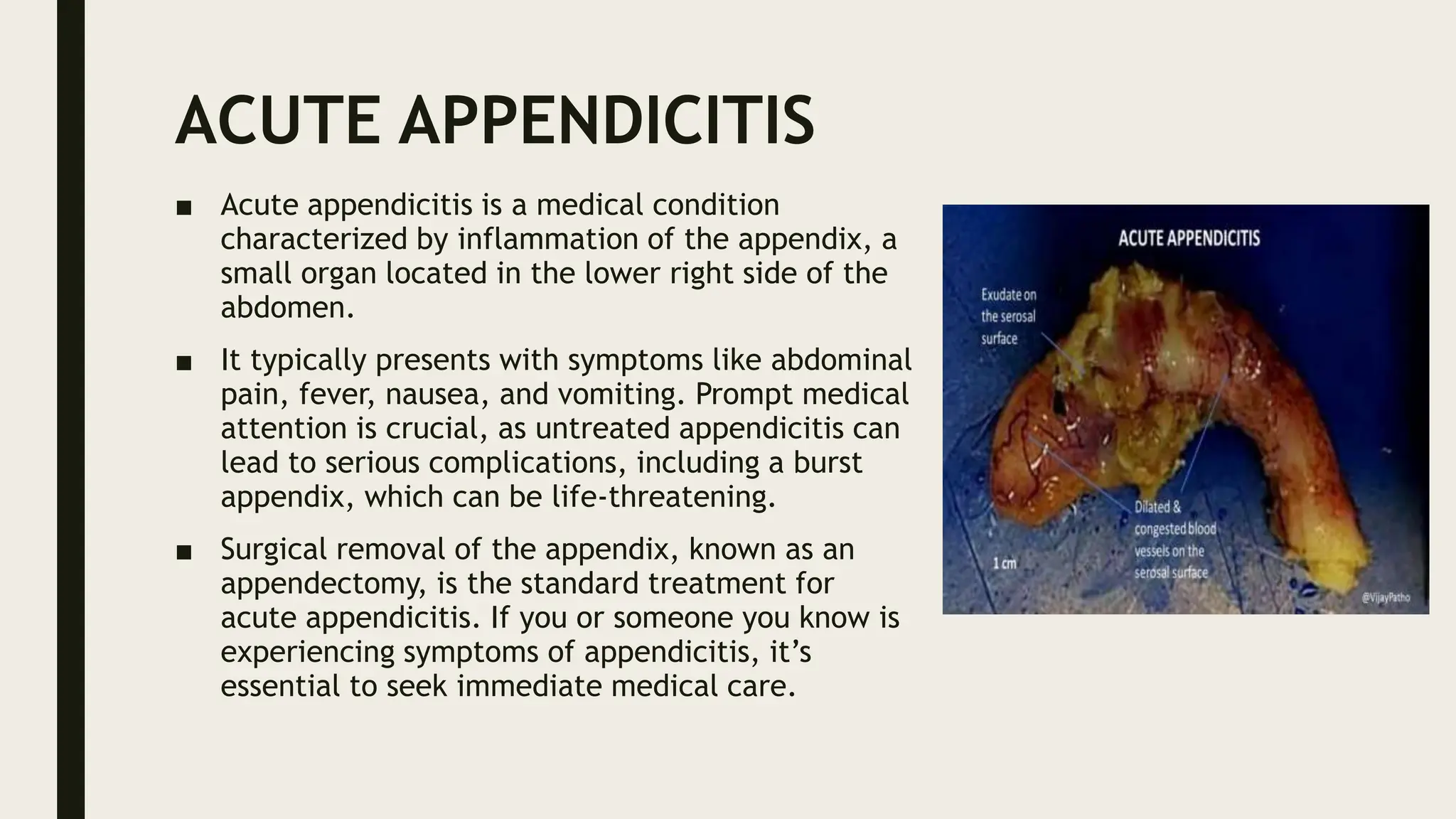 Acute appendicitis .pptx