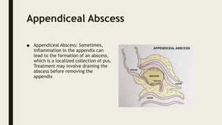 Acute appendicitis .pptx