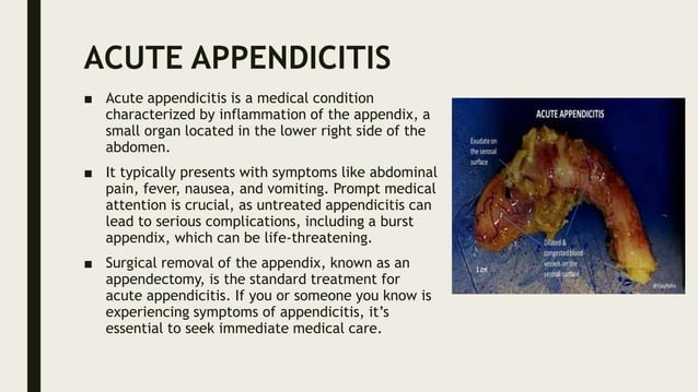 Acute appendicitis .pptx