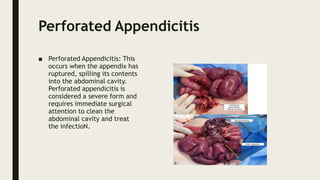 Acute appendicitis .pptx