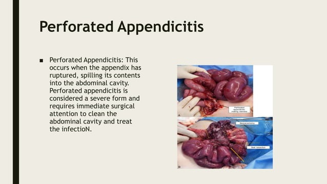 Acute appendicitis .pptx